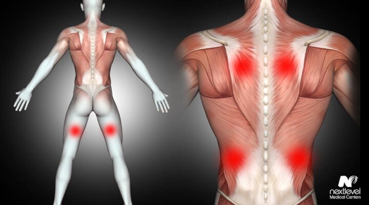 Everything You Need to Know About Trigger Point Therapy